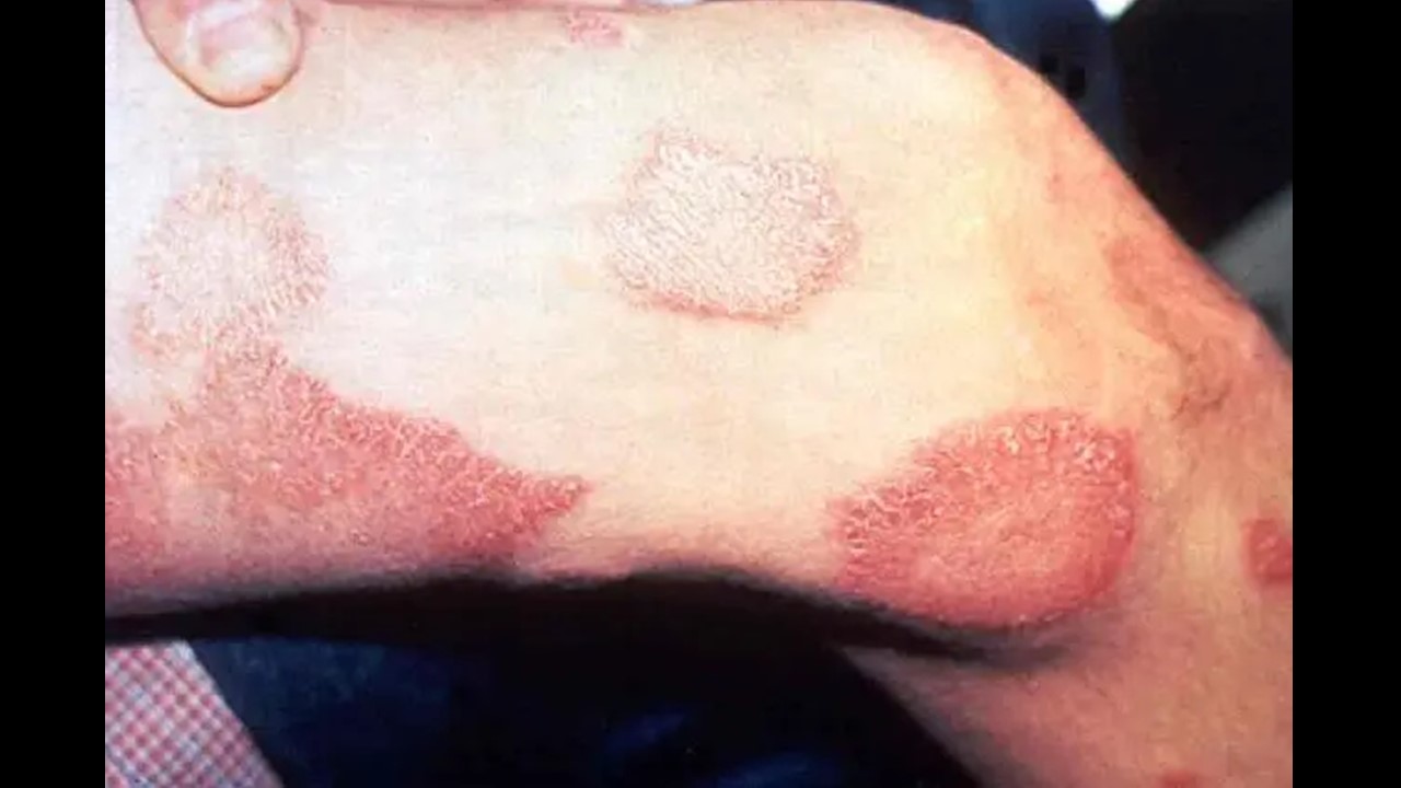 Lepra en México: ¿Cuántos casos confirmados hay en el país? (nota de ...